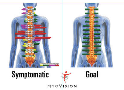 Myovision | Carlson Chiropractic